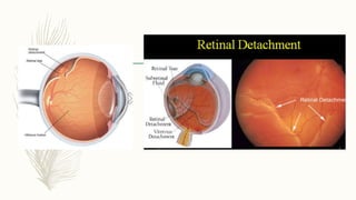 Retina - Congenital anomalies and RD by Ashith Tripathi | PPTX