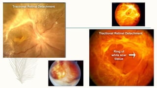 Retina - Congenital anomalies and RD by Ashith Tripathi | PPTX