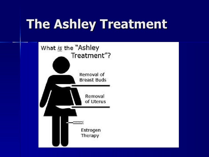 Ashley X The “ashley Treatment”