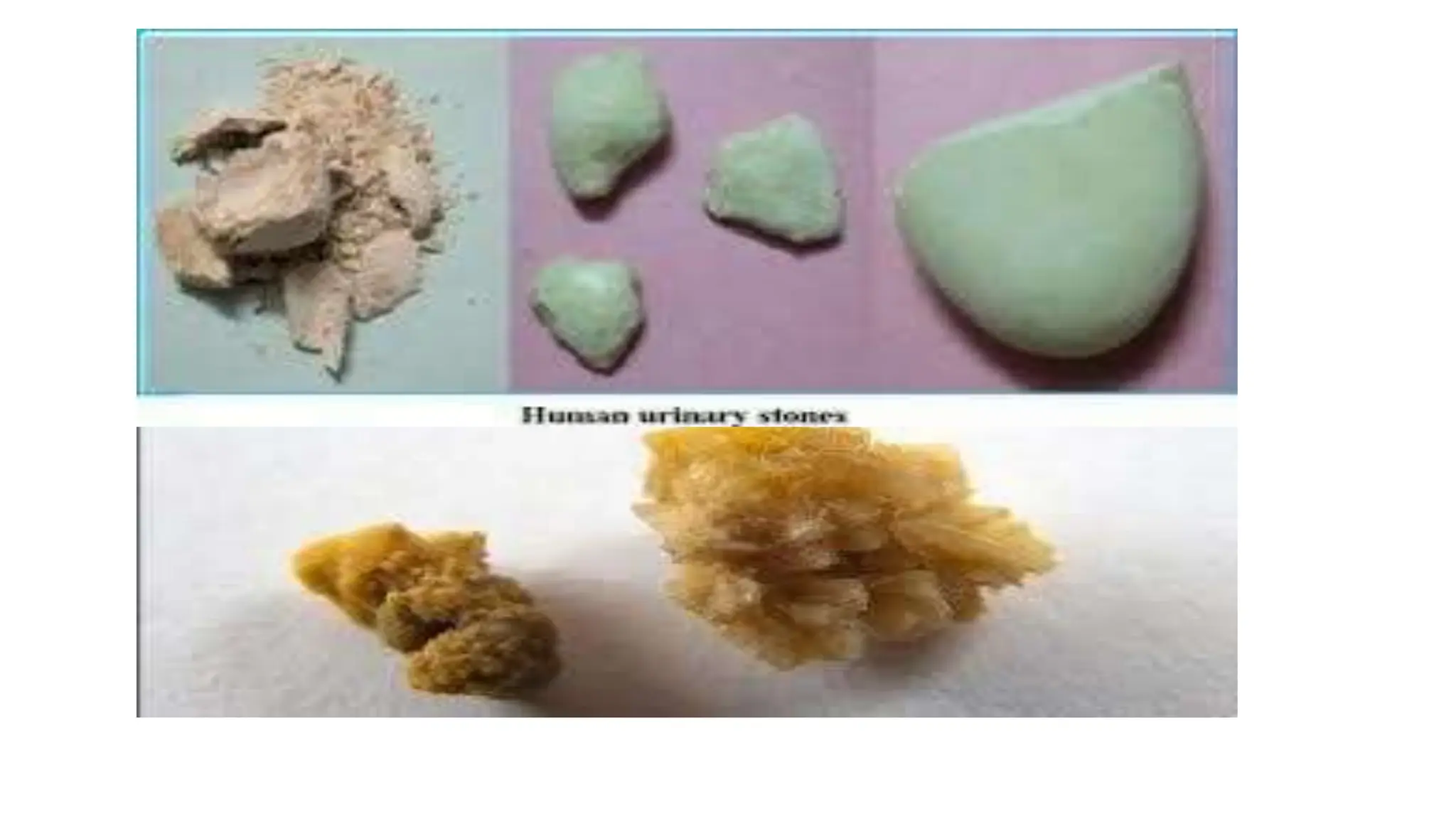 Ashmari (Urinary Calculi) Pathology & Diagnosis | PPTX