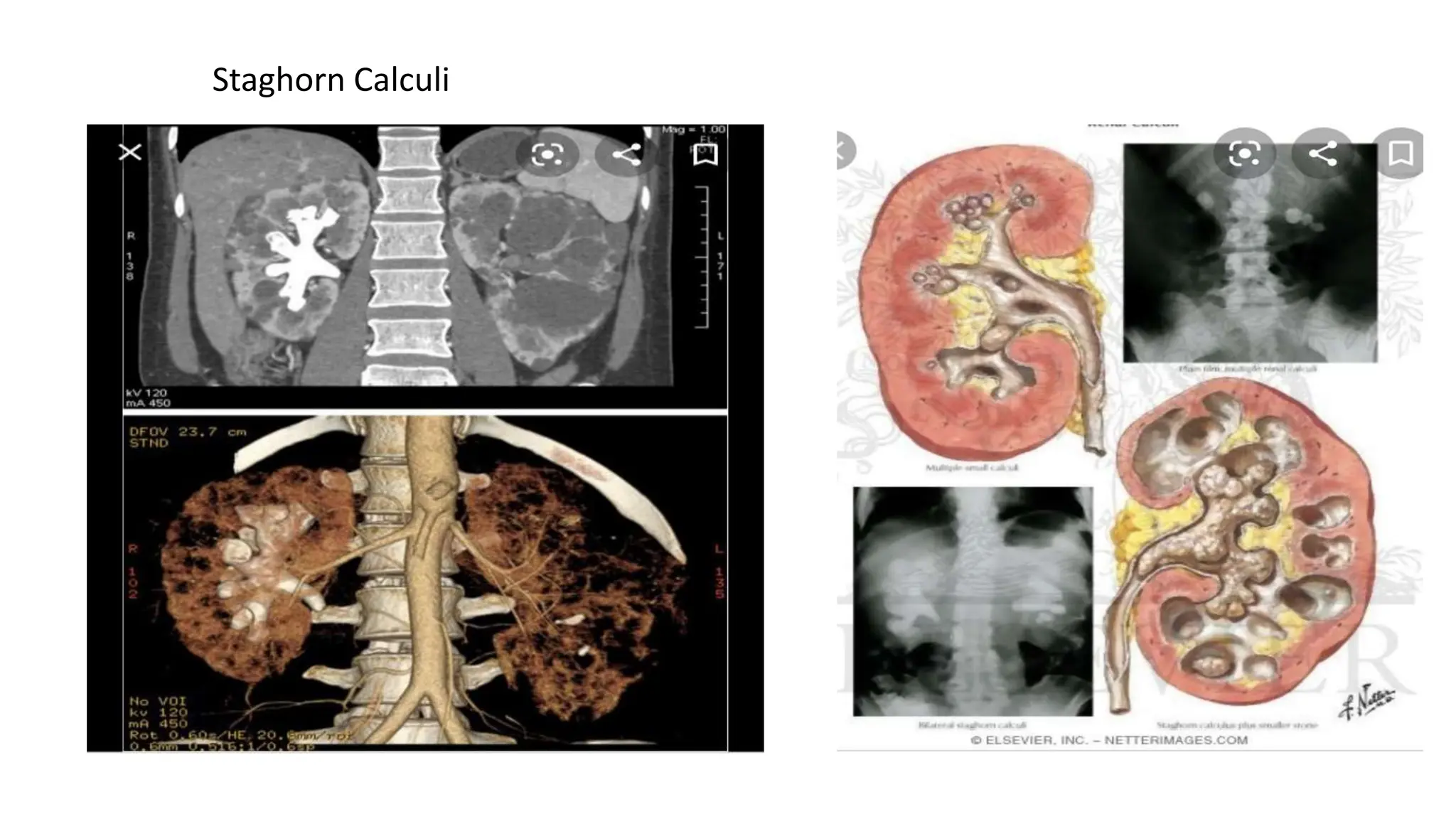 Ashmari (Urinary Calculi) Pathology & Diagnosis | PPTX