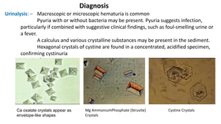 Ashmari (Urinary Calculi) Pathology & Diagnosis | PPTX