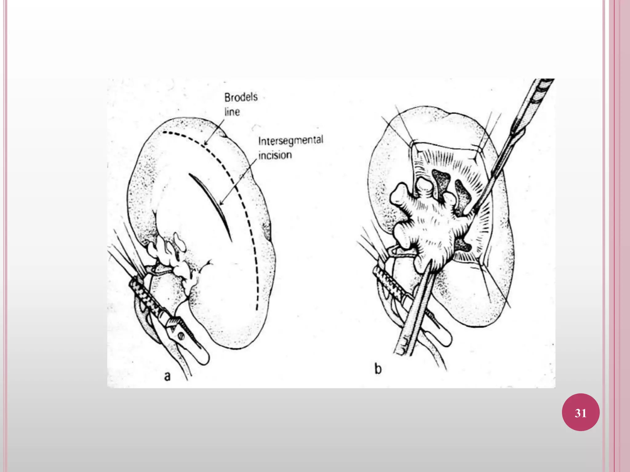 Kshara and shastra karma in the management of ashmari | PPTX | Surgery ...