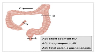 Colon Diseases, non specific ulcerative colitis | PPT