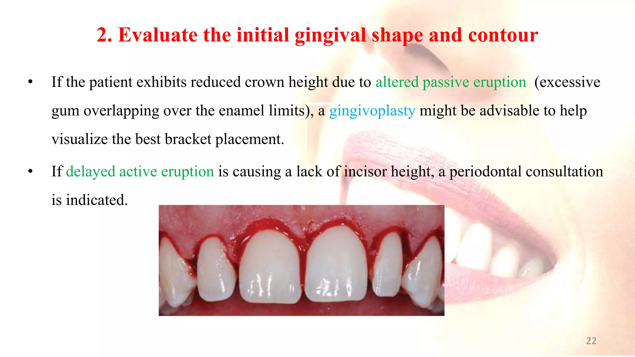 Bracket placement based on smile esthetics | PPTX