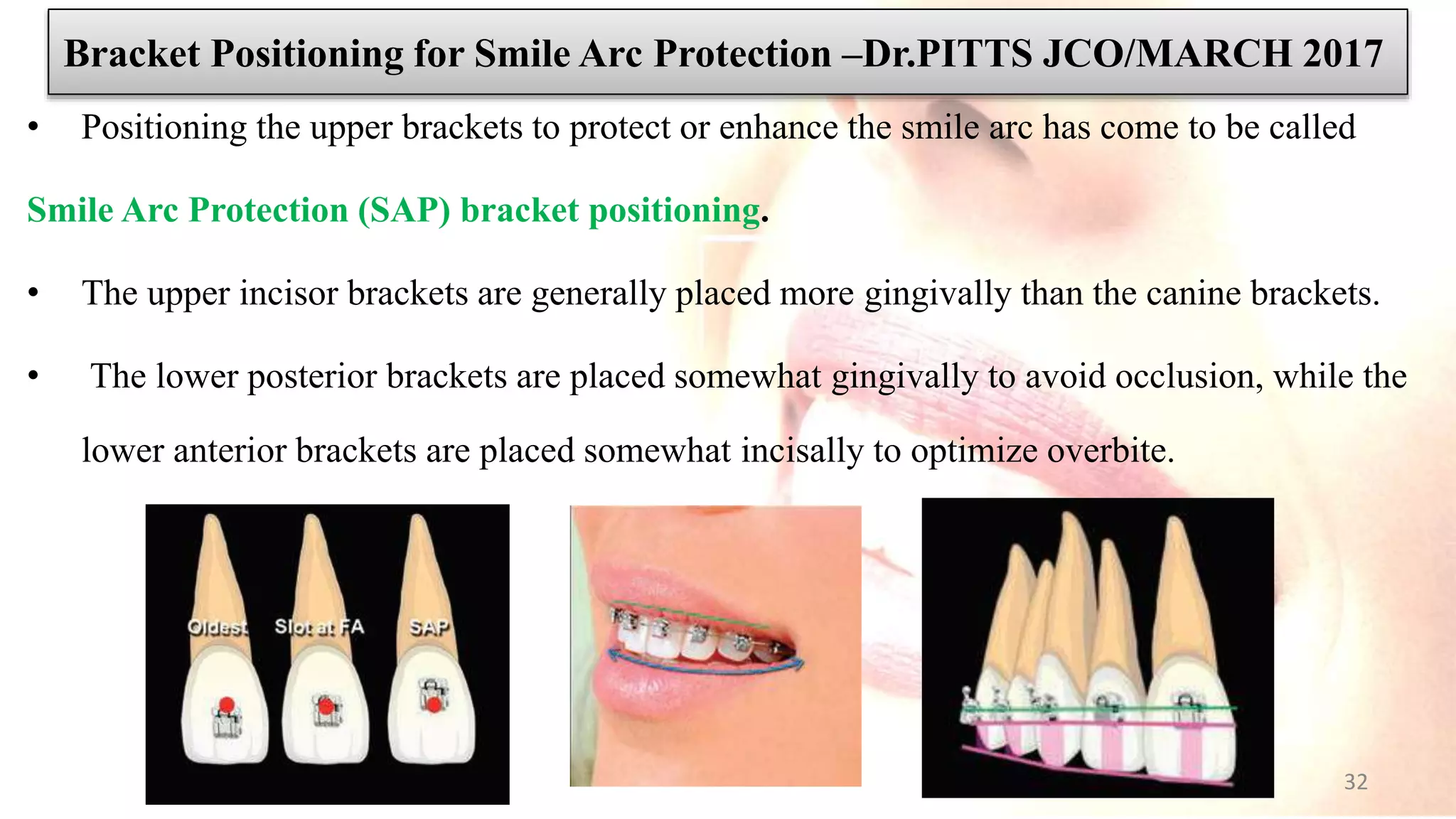 Bracket placement based on smile esthetics | PPTX