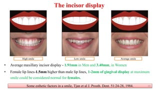 Bracket placement based on smile esthetics | PPTX