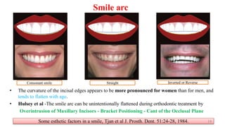 Bracket placement based on smile esthetics | PPTX