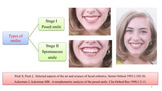 Bracket placement based on smile esthetics | PPTX