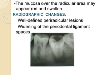 PERIAPICAL DISEASES | PPTX