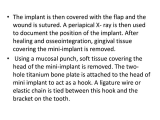 MINI IMPLANTS IN ORTHODONTICS | PPTX