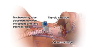 Tracheostomy).pptx. For bsc nursing students | PPTX