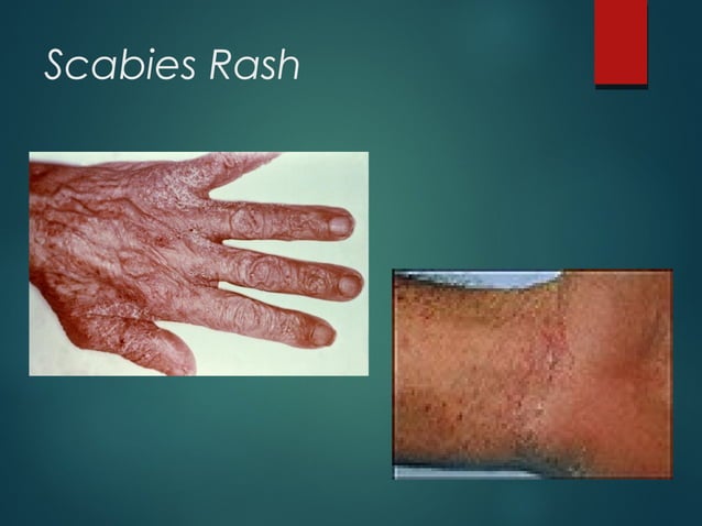A short guide to scabies treatment 2016 | PPT