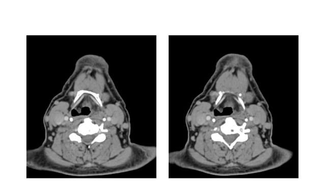 Case of laryngeal carcinoma for total laryngectomy | PPTX