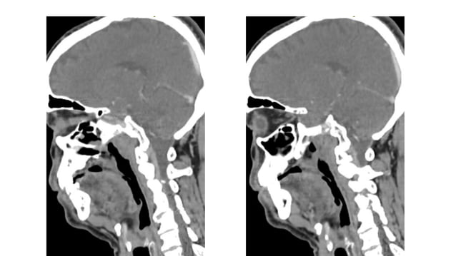 Case of laryngeal carcinoma for total laryngectomy | PPTX