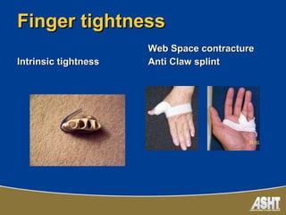 Asht-ca chapter splinting | PPT