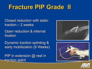 Asht-ca chapter splinting | PPT