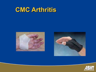 Asht-ca chapter splinting | PPT
