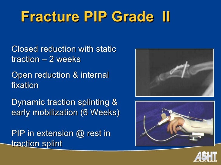 Asht-ca chapter splinting
