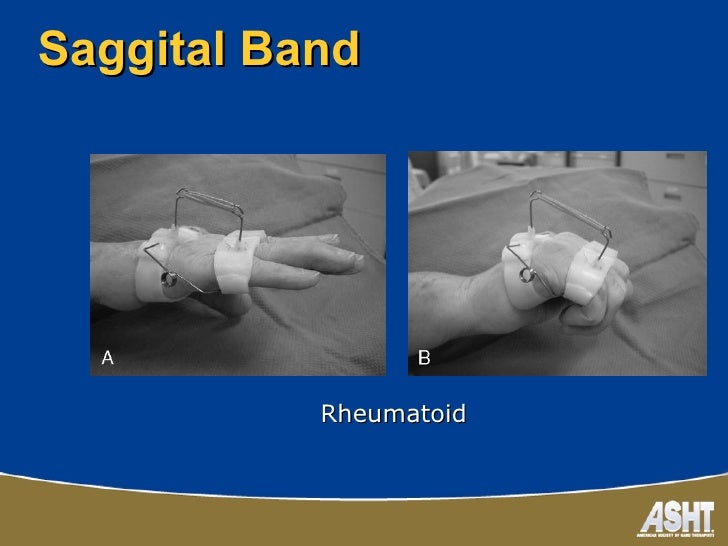 Asht-ca chapter splinting