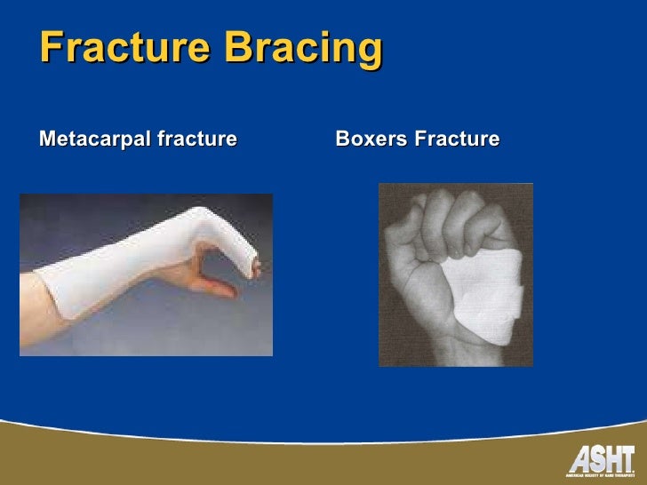 Asht-ca chapter splinting