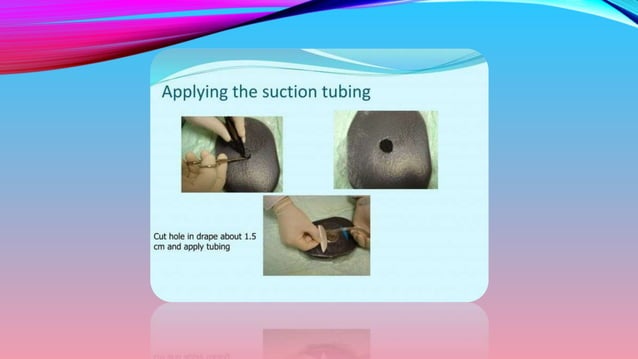 Vacuum asssited wound therapy for buns management | PPT