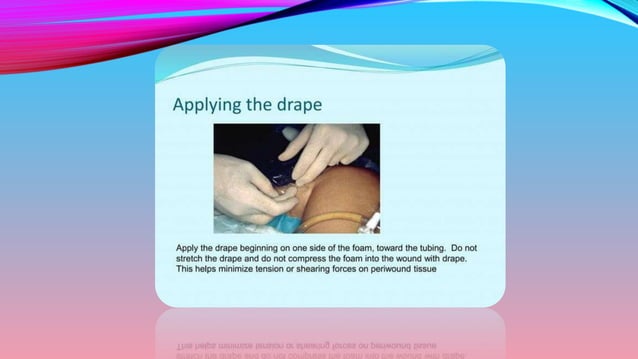 Vacuum asssited wound therapy for buns management | PPT