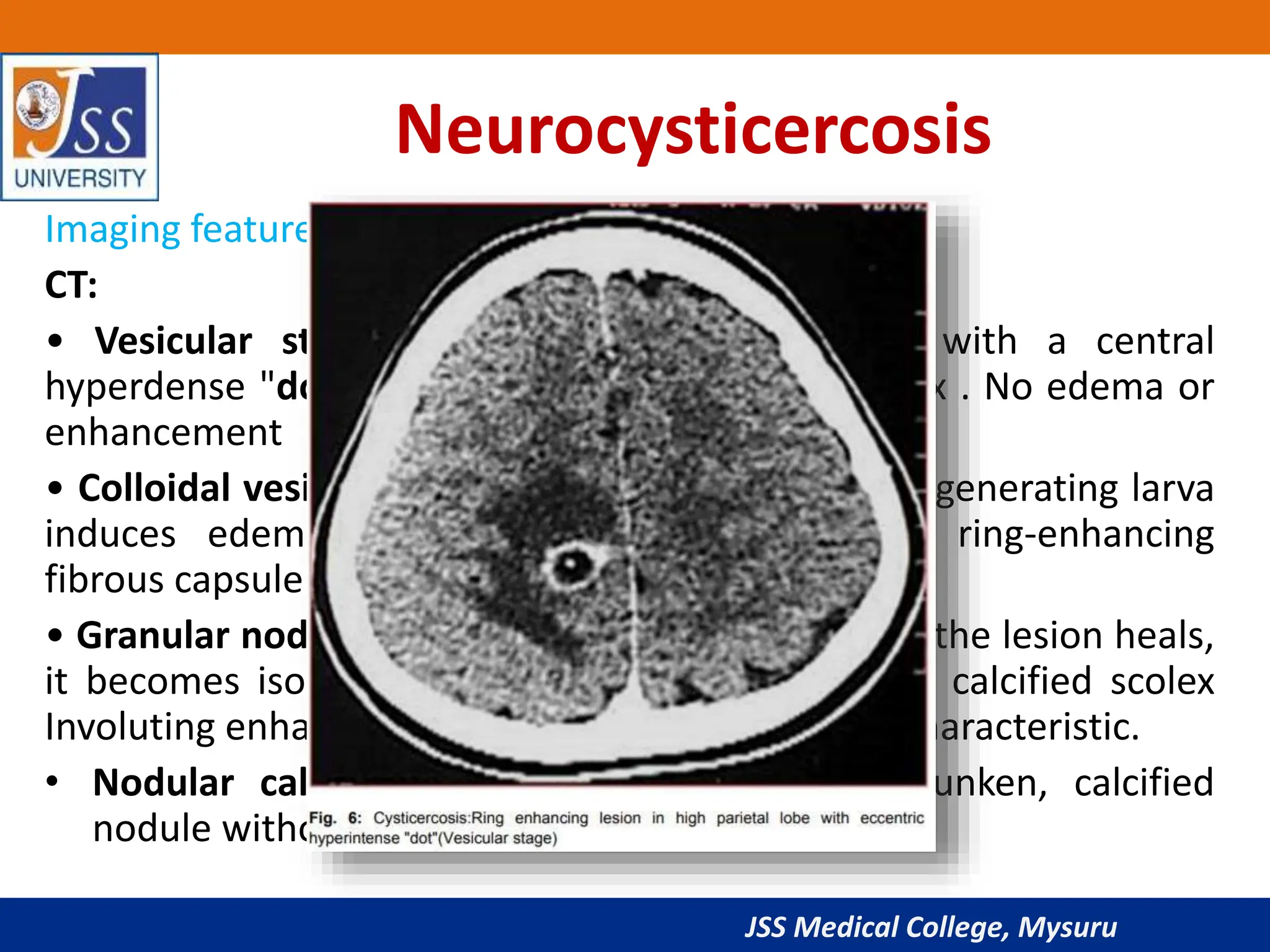 ring enhancing lesions¹111222222222111112 | PPT