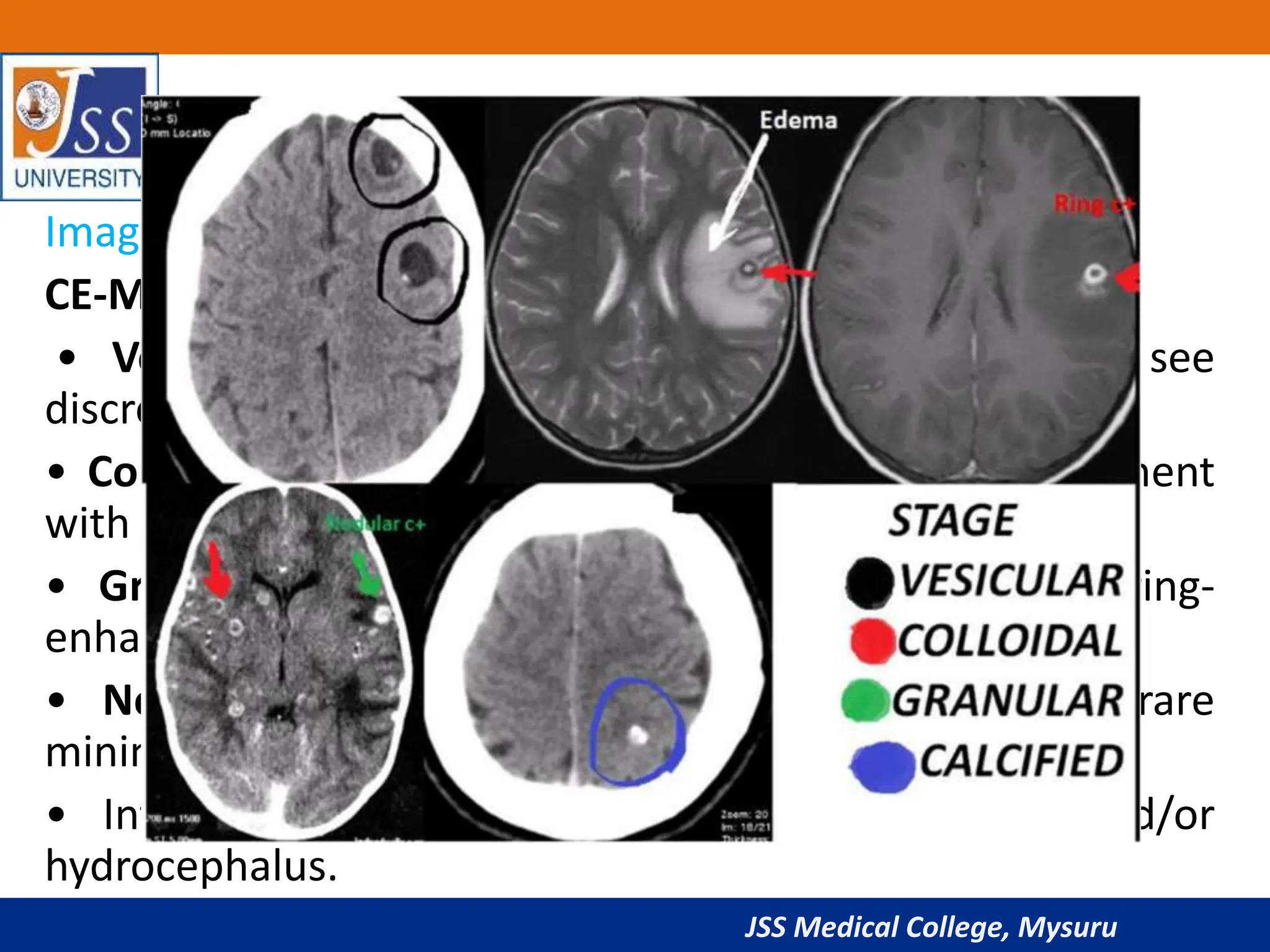ring enhancing lesions¹111222222222111112 | PPT