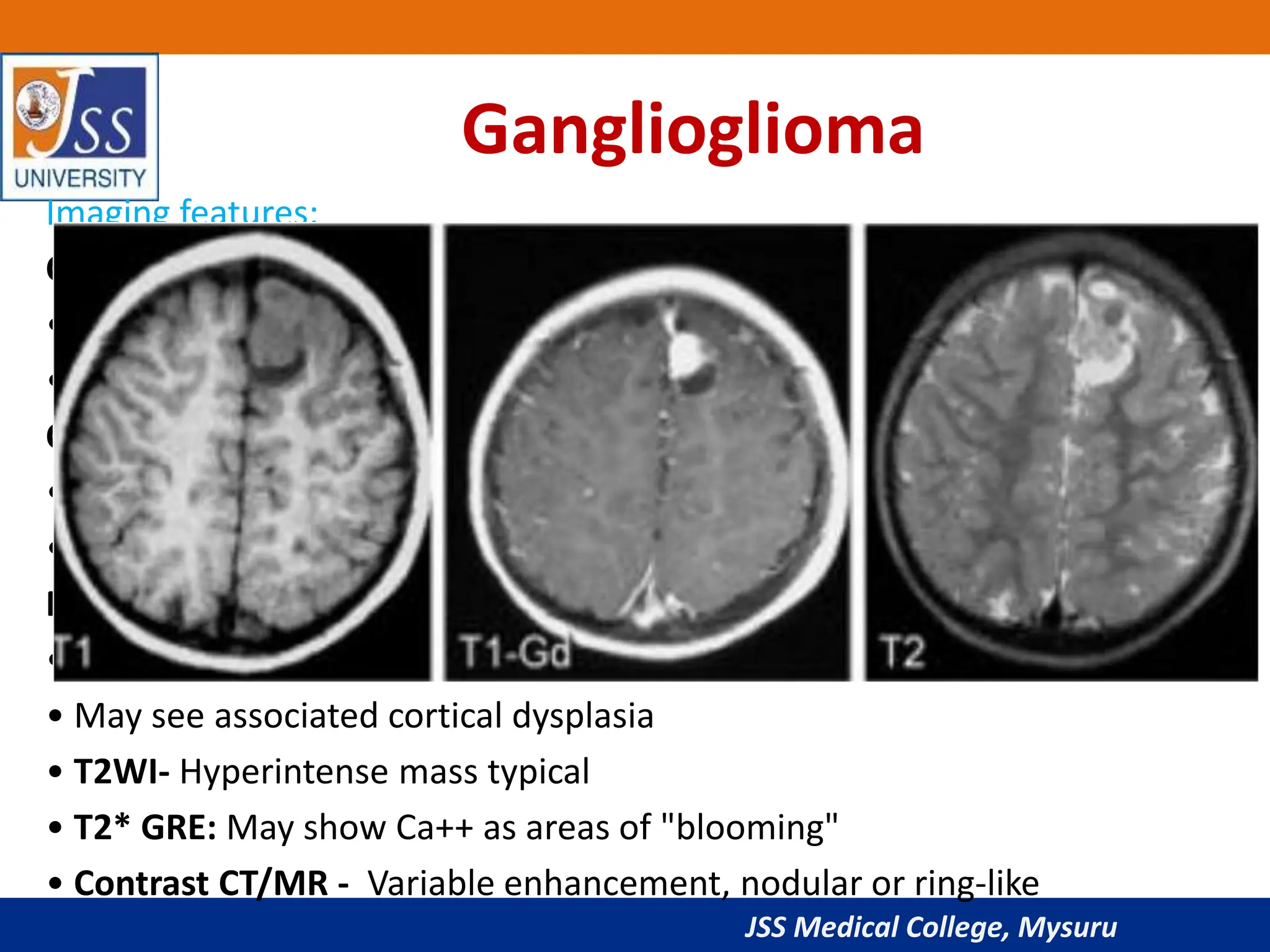 ring enhancing lesions¹111222222222111112 | PPT