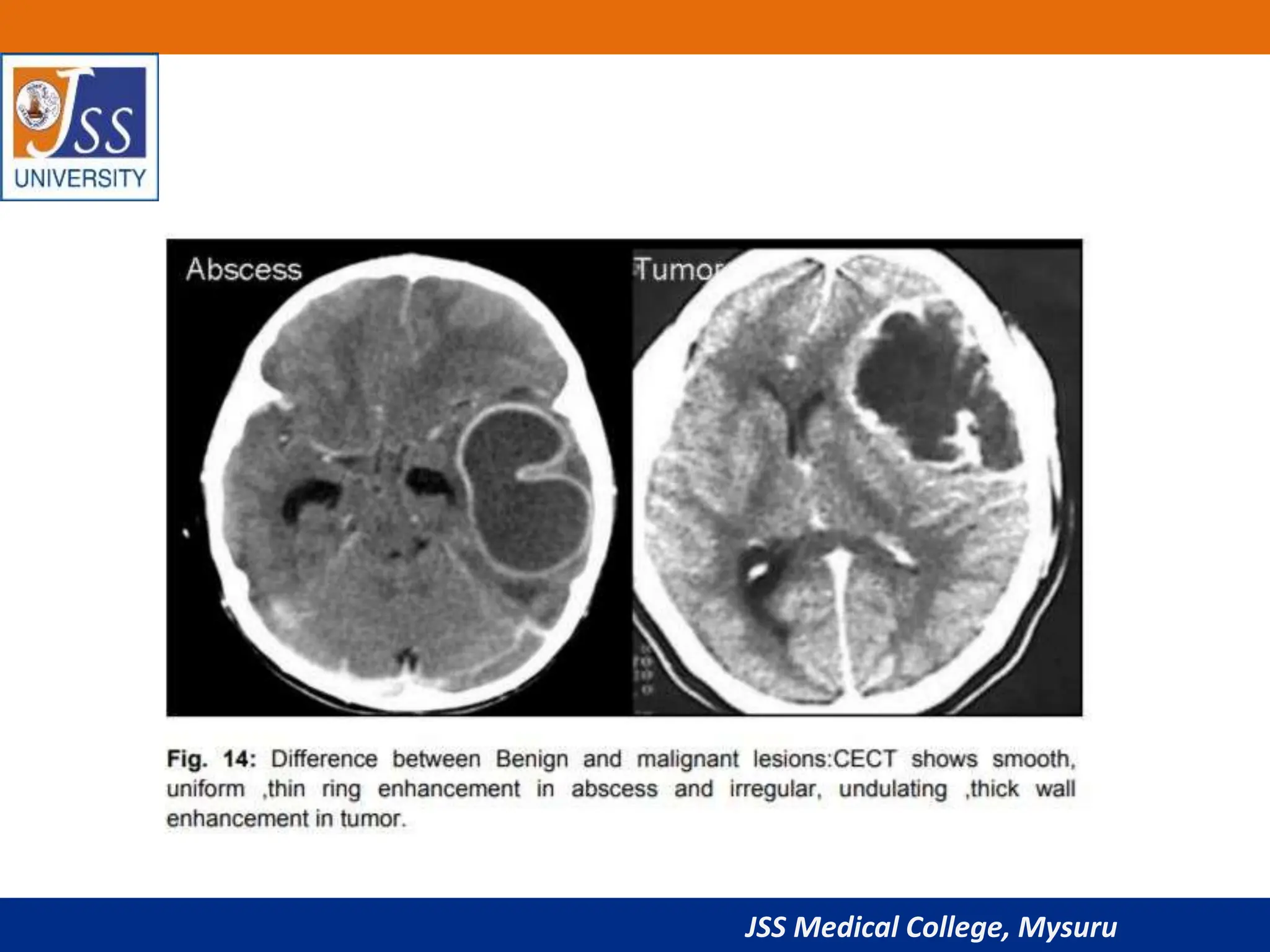 ring enhancing lesions¹111222222222111112 | PPT