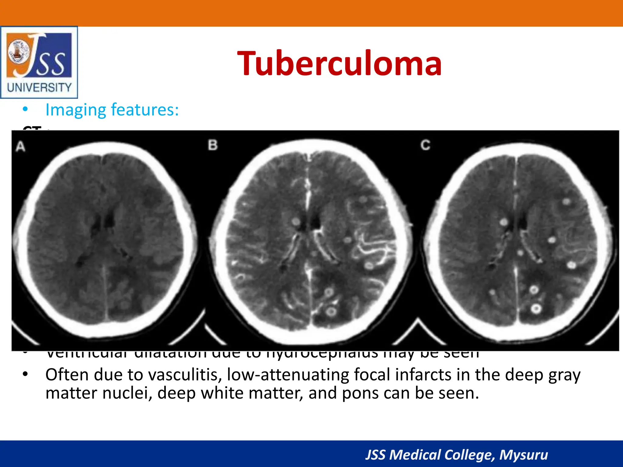 ring enhancing lesions¹111222222222111112 | PPT