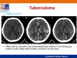 ring enhancing lesions¹111222222222111112 | PPT