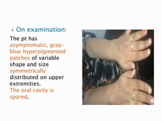 Ashy Dermatosis Cure