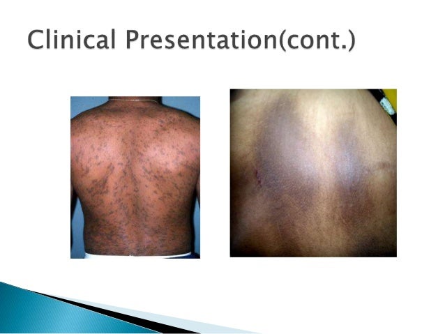 Ashy dermatosis