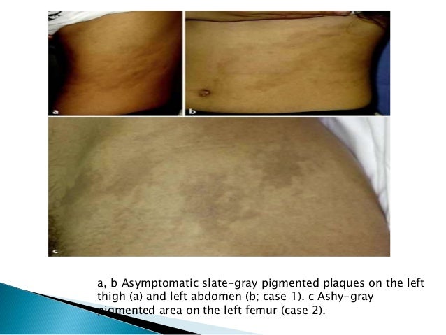 Ashy dermatosis