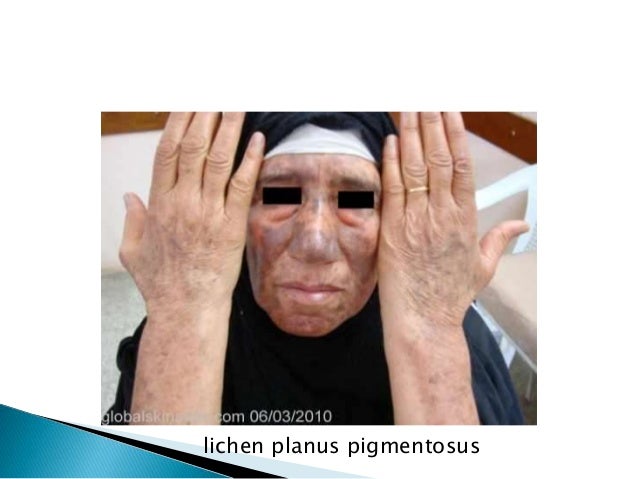 Ashy dermatosis