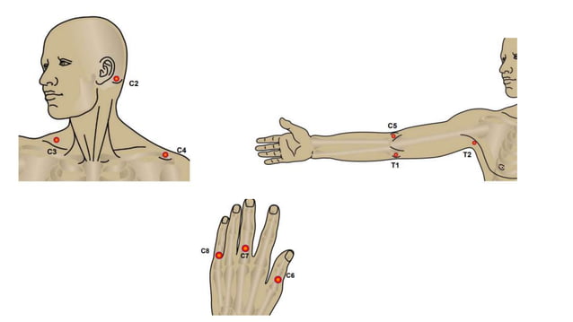 ASIA Scale.pptx | Death, Injury, or Military Conflict | Sensitive Topics