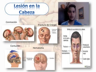 Lesion en la Cabeza | PPTX