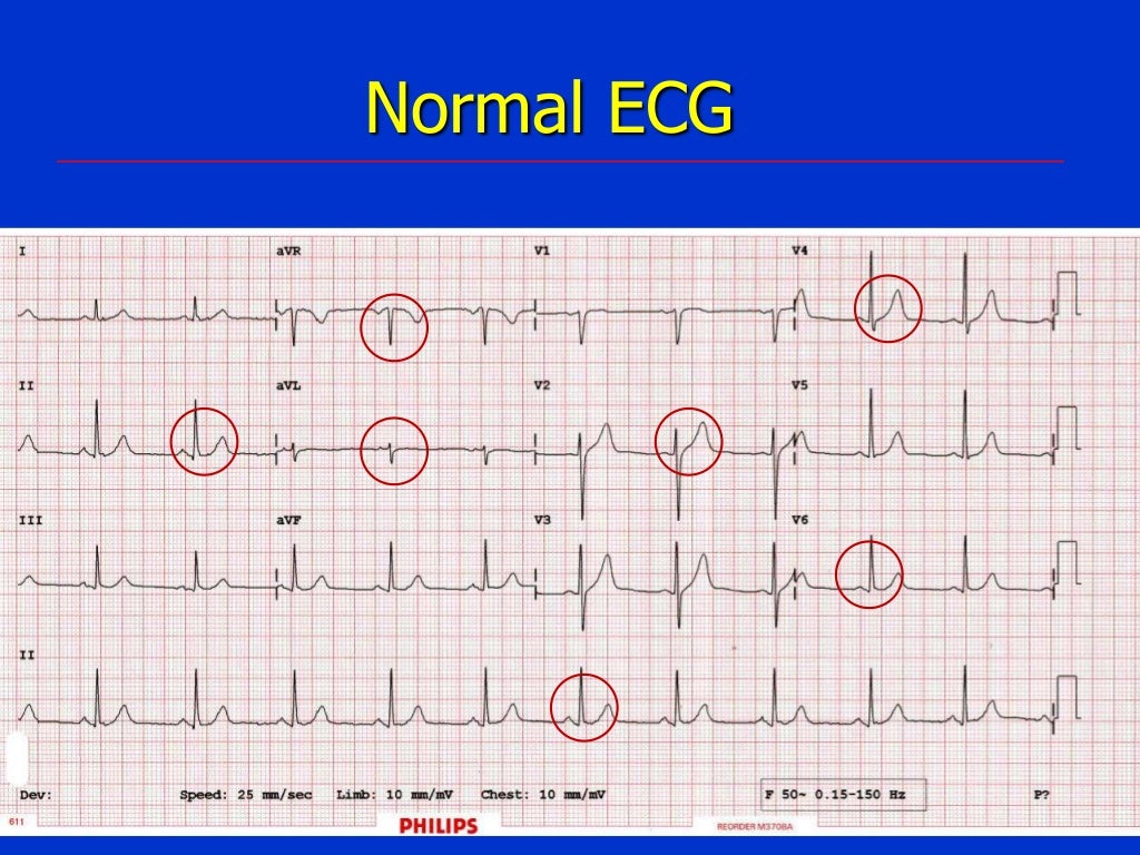 Acute Coronary Syndrome (NSTEMI)