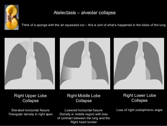 A simple guide_to_cxr_interpretation