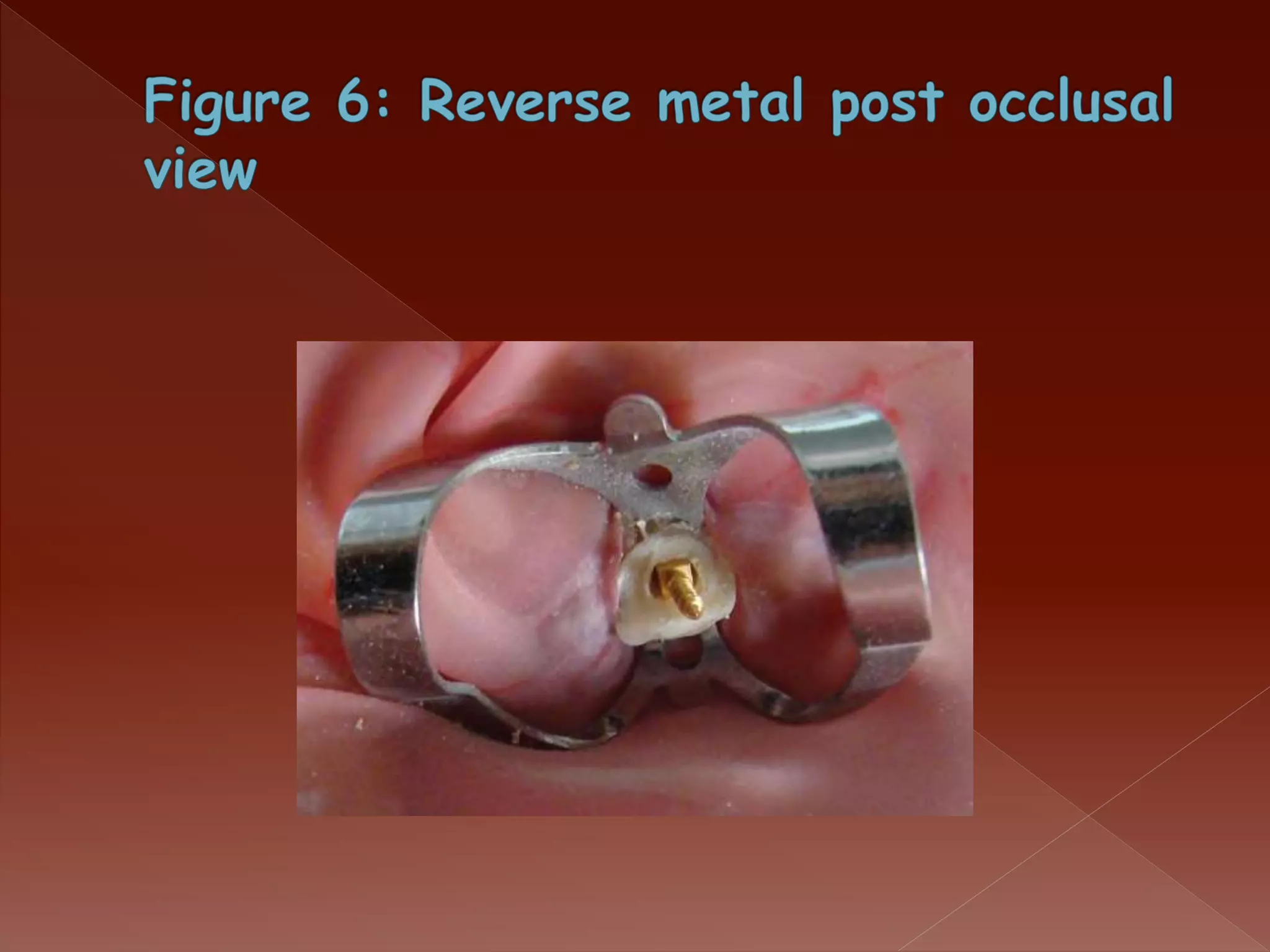 A simple method for reconstruction of severely damaged primary anterior ...