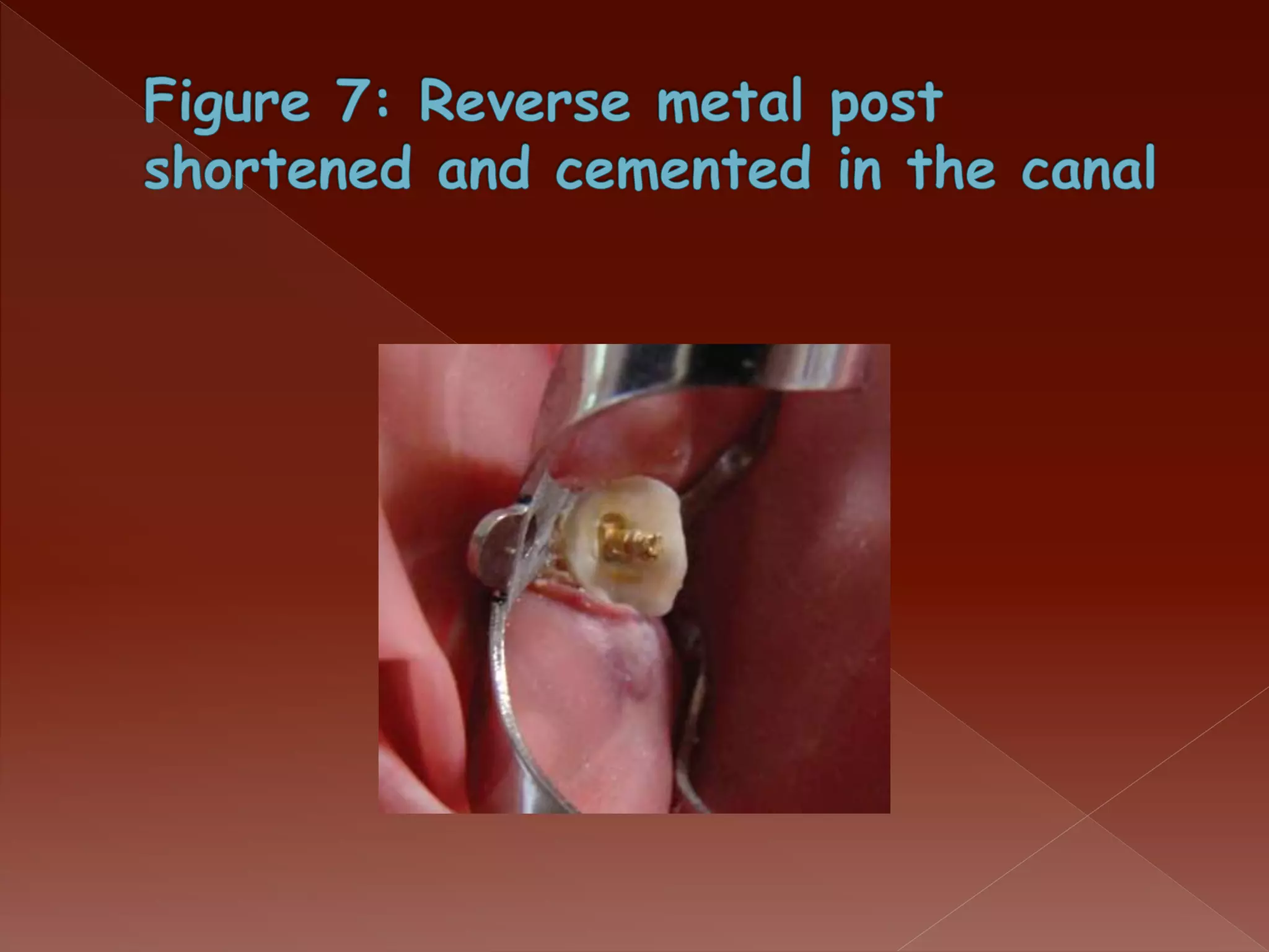 A simple method for reconstruction of severely damaged primary anterior ...
