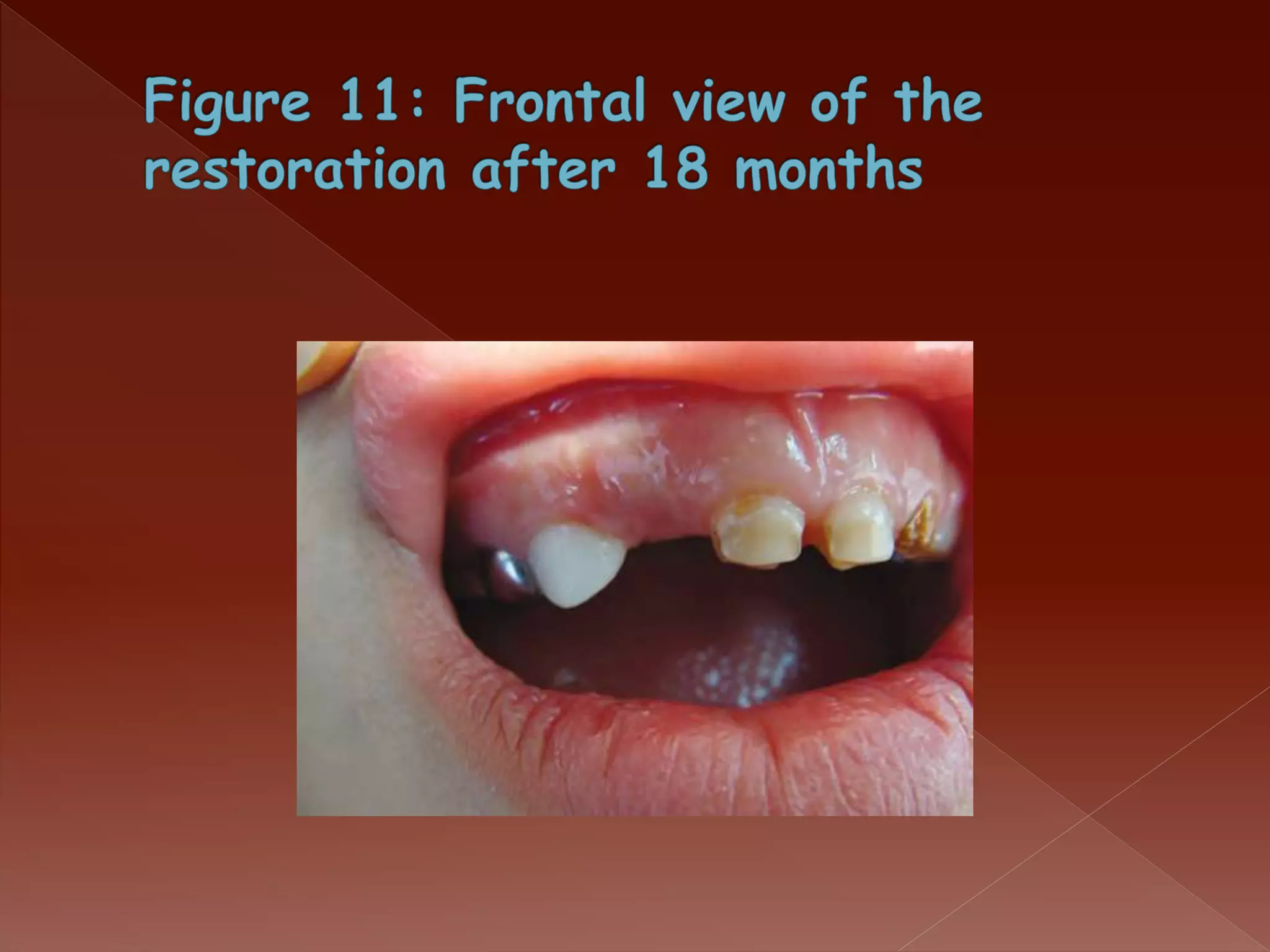 A simple method for reconstruction of severely damaged primary anterior ...