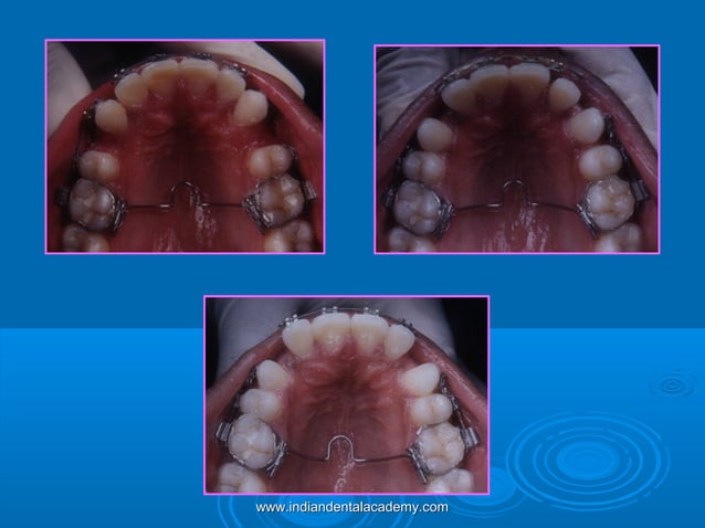 A simplified approach towards pg canine retraction spring | PPT | Free ...