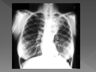 Askep abses paru | PPT