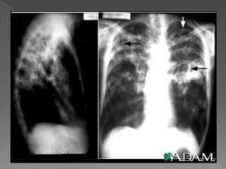 Askep abses paru | PPT