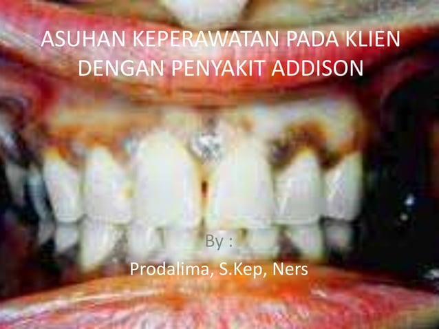 Asuhan Keperawatan Pada Klien Dengan Addison | PPTX