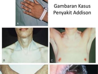 Asuhan Keperawatan Pada Klien Dengan Addison | PPT