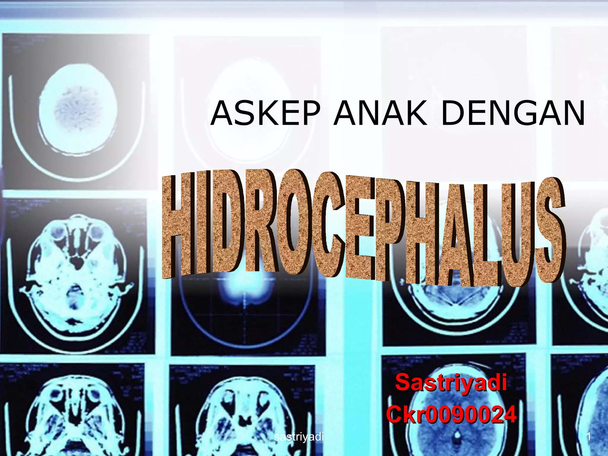 Askep anak hydrocephalus3 (hidrosefalus) | PPT